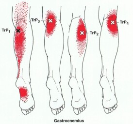 Alles over triggerpoints bij kramp in de kuit & oplossing