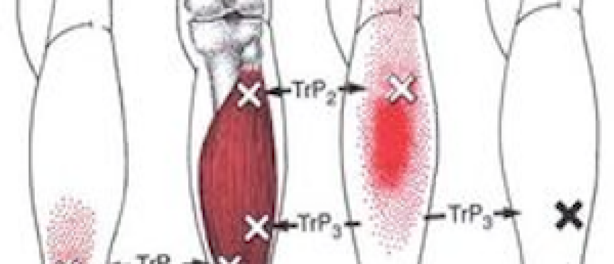 Alles over triggerpoints bij kramp in de kuit & oplossing
