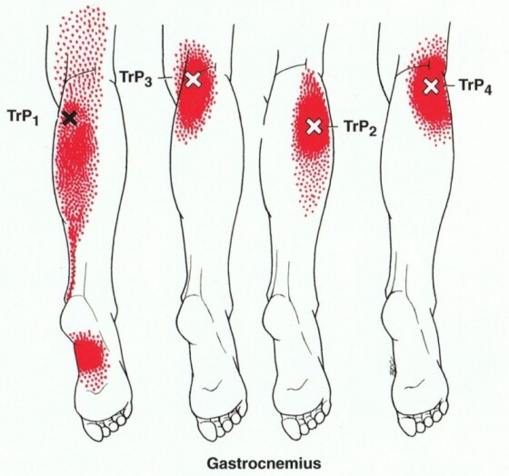 Alles over Triggerpoints in bovenbeen, hamstring knie