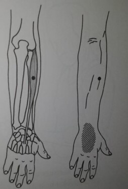 Alles over triggerpoints arm, elleboog, hand en vingers