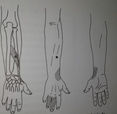 Alles over triggerpoints arm, elleboog, hand en vingers