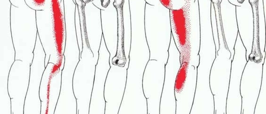 Pijn in de bil met uitstraling naar been en voet; hoe komt het? En hoe ...