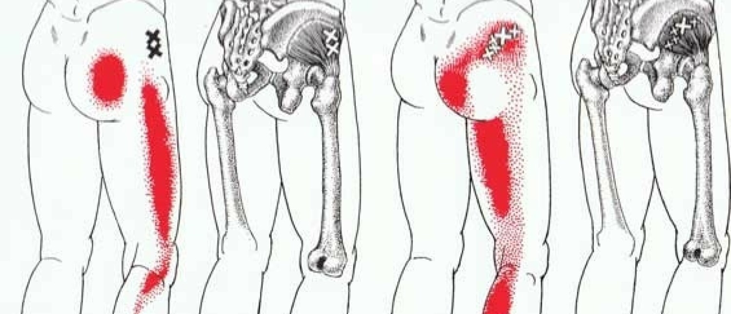 Piriformis syndroom test & oorzaak en behandeling