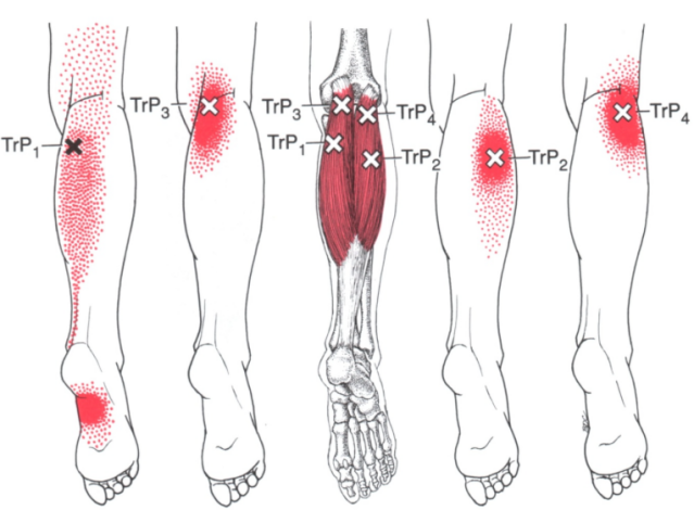Pijn in de bil met uitstraling naar been en voet; hoe komt het? En hoe ...