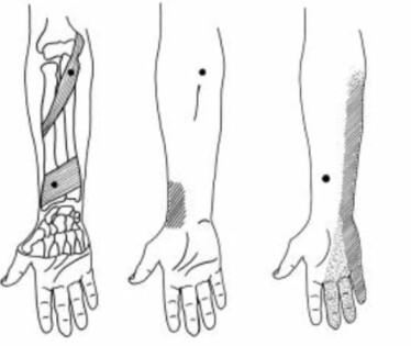 Alles over pijn in de onderarm- oorzaak en behandeling