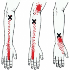 Alles over pijn in de onderarm- oorzaak en behandeling