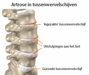 Alles over midden rugpijn- oorzaak en behandeling