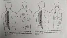 Alles over pijn in de bovenrug-oorzaken en behandeling