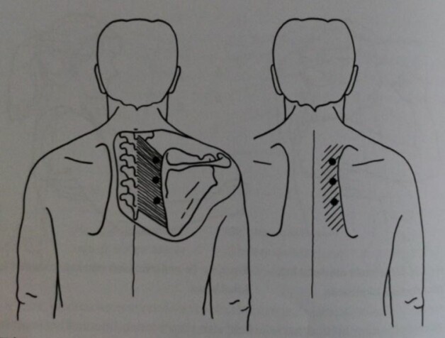 Alles over pijn in de bovenrug-oorzaken en behandeling