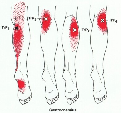 Alles over Pijn het Bovenbeen- oorzaken en behandeling