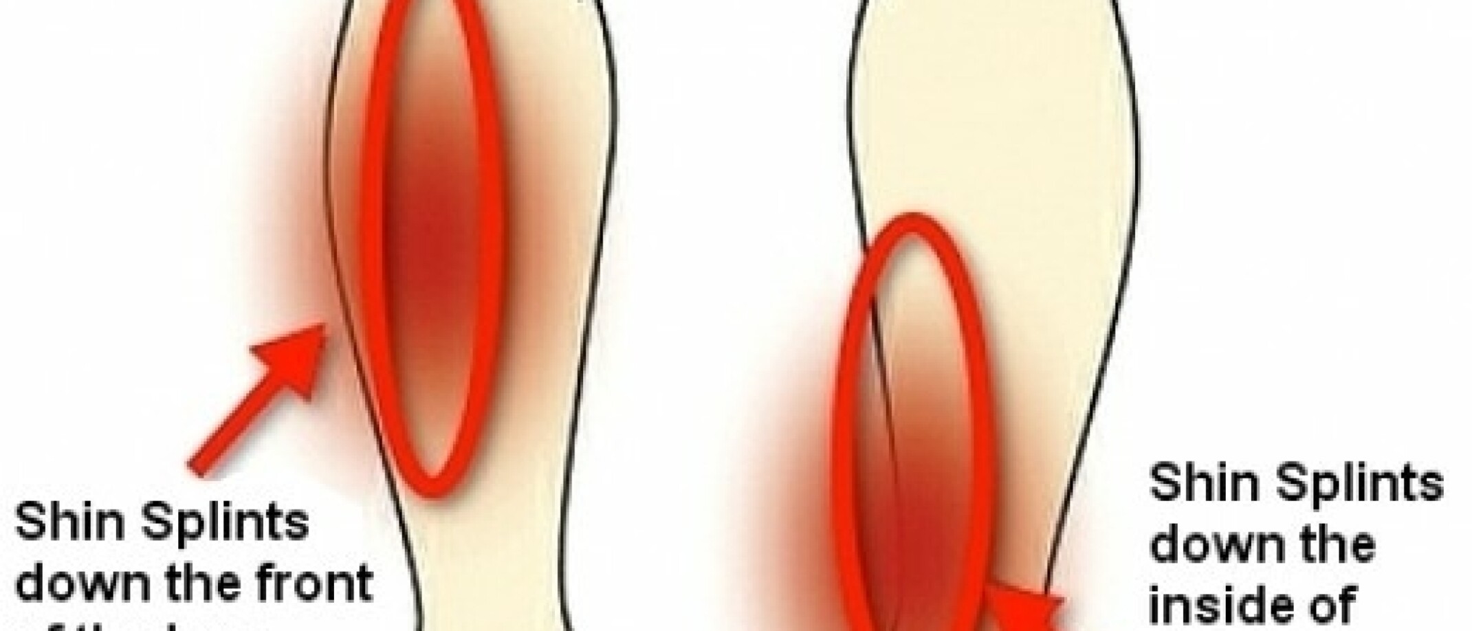 Alles over pijn in het scheenbeen- oorzaken en behandeling