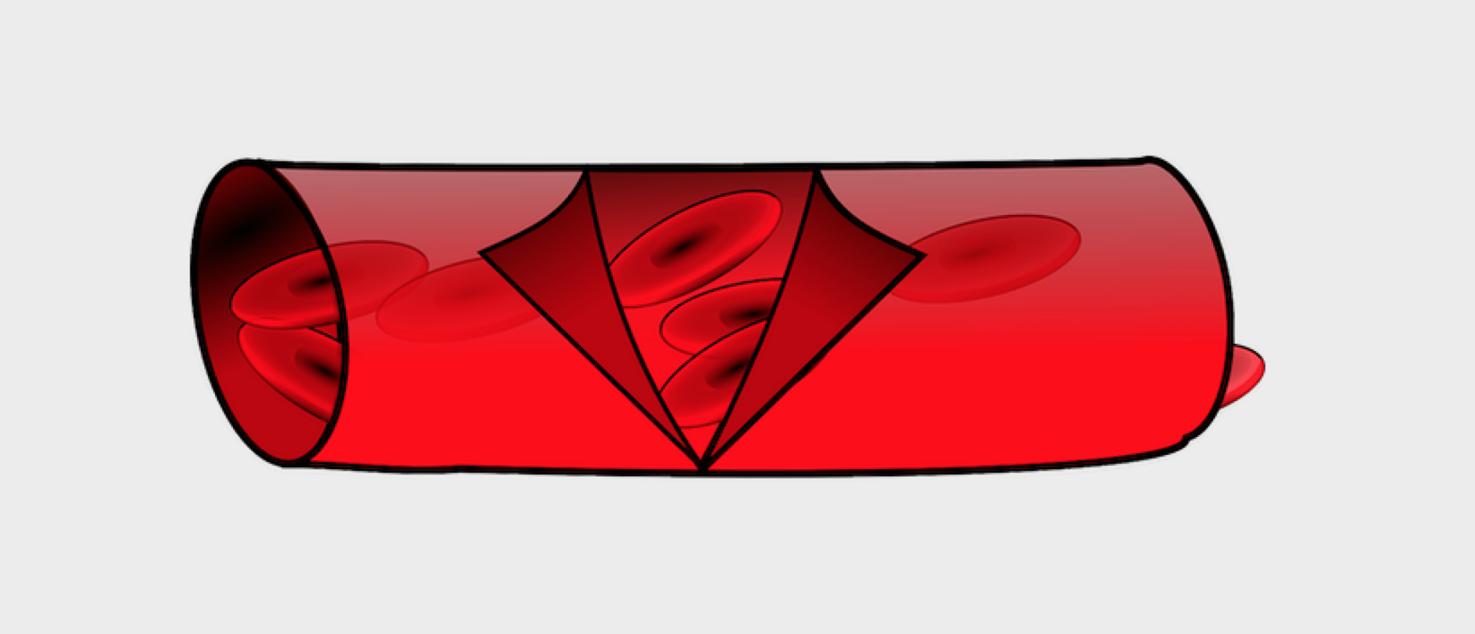 Aderverkalking of Atherosclerose