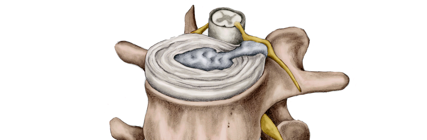 Wat is een Hernia? | Het ontstaan, de symptomen en behandeling