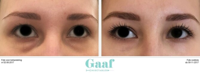 Traangoot filler behandeling