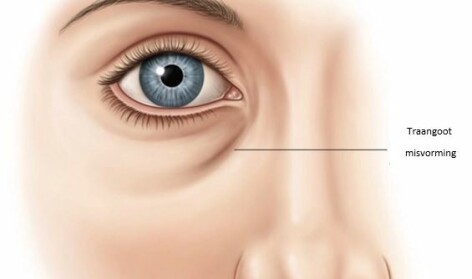 Traangoot filler behandeling