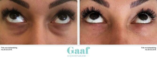 Traangoot filler behandeling