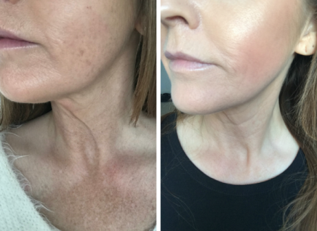 Profhilo | ervaringen 9,6 | #1 in anti aging | Gaaf Injectables