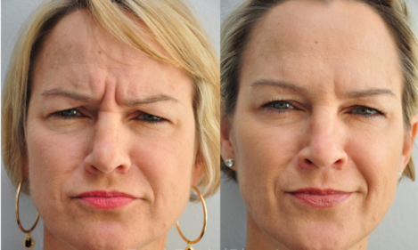 Fronsrimpel botox | # 1 verjongende behandelingen | Gaaf Injectables