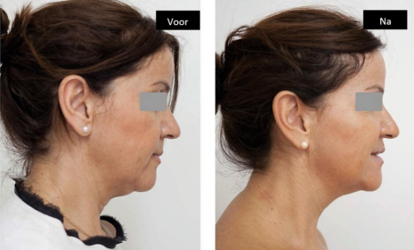 Profhilo behandeling | Profhilo ervaringen 9,6 klantwaardering