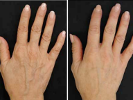 Profhilo behandeling | Profhilo ervaringen 9,6 klantwaardering