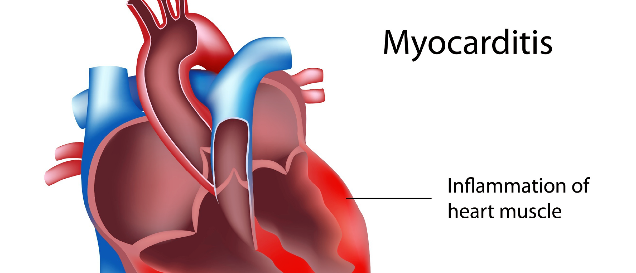 Myocarditis