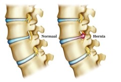 Hernia Nuclei Pulposi | Door de Lage Rugpijn Fysio