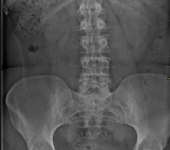 Rontgenfoto Lage Rug