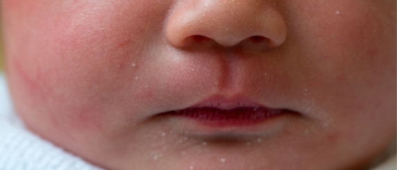 Een baby met puistjes? Baby acné