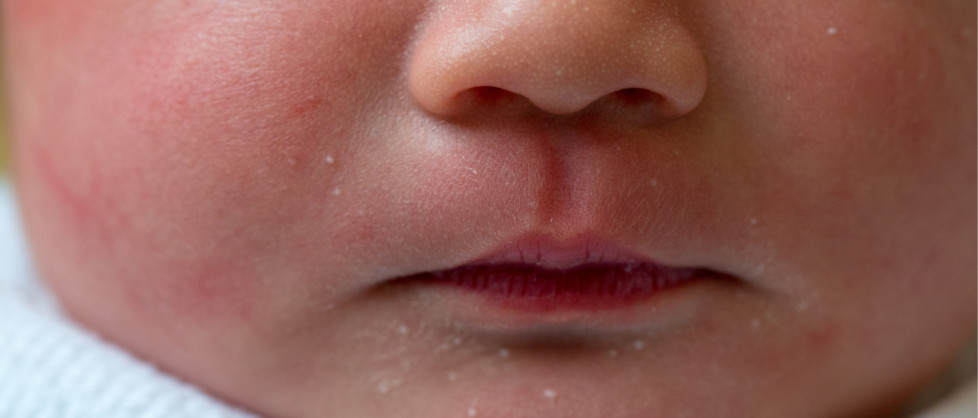 Een baby met puistjes? Baby acné