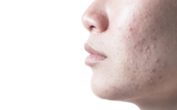 Acne Vulgaris | Dermatologie