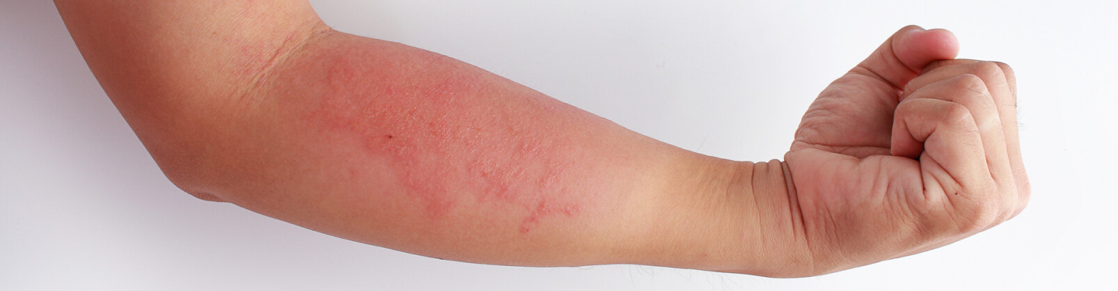 Eczeem | Dermatologie