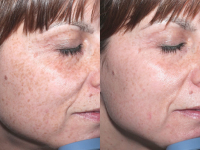 Pigment behandeling MeLine l Dé behandeling tegen pigmentvlekken