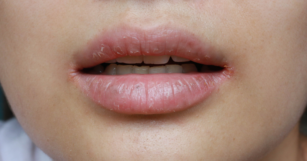 Gratis productadvies | Lippenbalsem droge lippen | Sproet