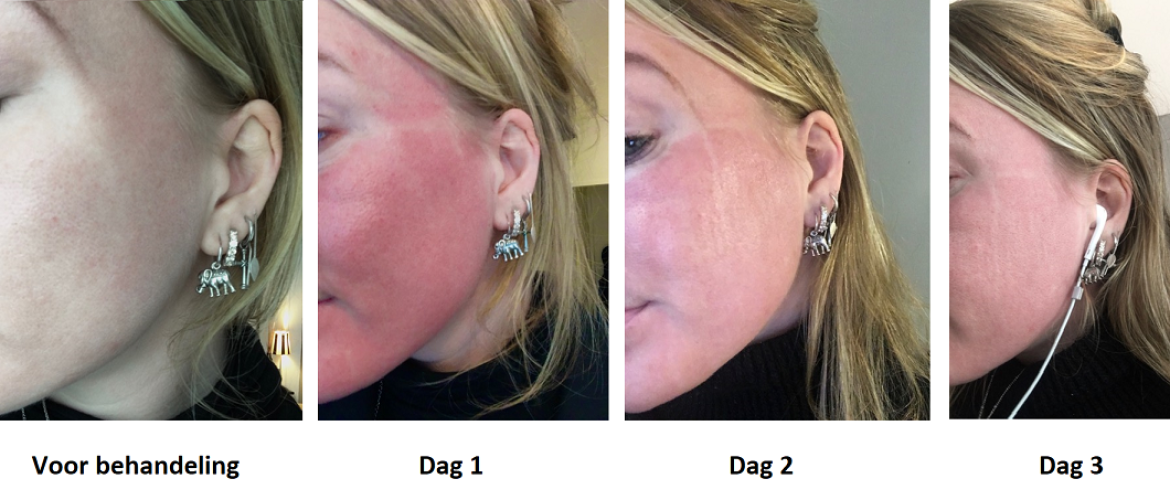 Dermatitis periocularis: rode uitslag rond ogen