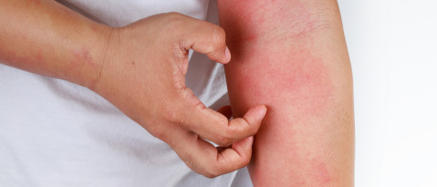 Urticaria: jeukende rode galbulten