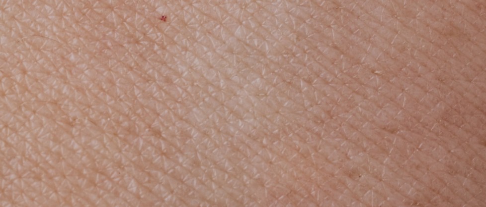 Poikiloderma van civatte: gesprongen adertjes, pigmentvlekjes en atrofie