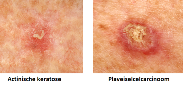 Plaveiselcelcarcinoom: huidkanker