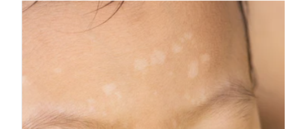 Basaalcelcarcinoom: huidkanker