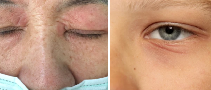 Dermatitis periocularis | Rode uitslag rond ogen | Sproet