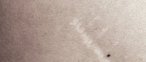 Littekens | Verschillende soorten, oorzaken en tips | Sproet