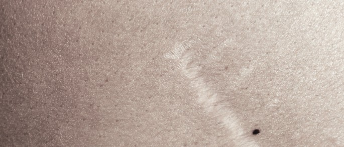 Keloïd littekens | Oorzaak en behandeling | Sproet