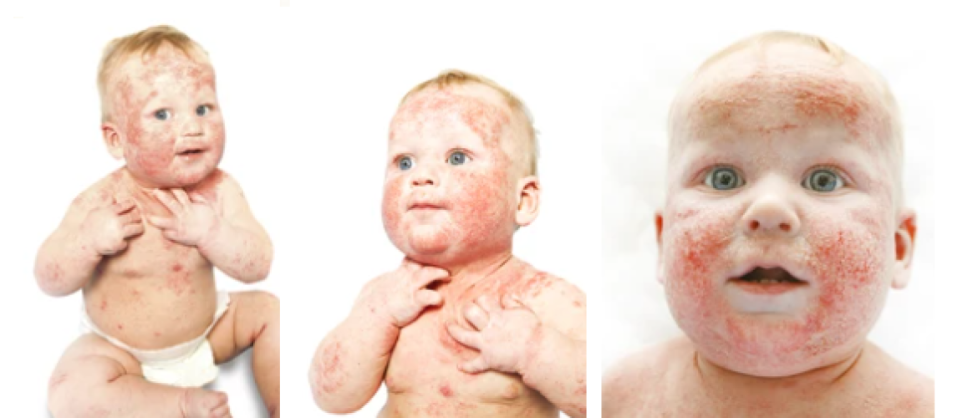 Dauwworm: atopisch eczeem baby | Oplossing | Sproet