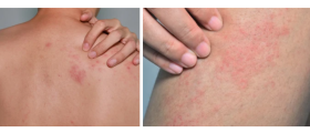 Dermatitis periocularis | Rode uitslag rond ogen | Sproet