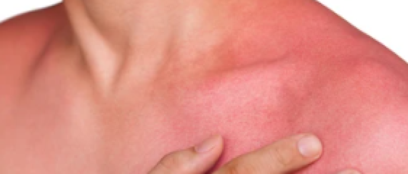 Verbrand door de zon: een rode huid | Oplossing en tips | Sproet