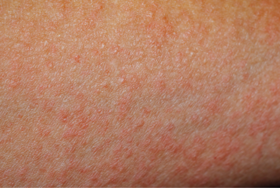 Winterbenen | Oorzaak en behandeling | Sproet