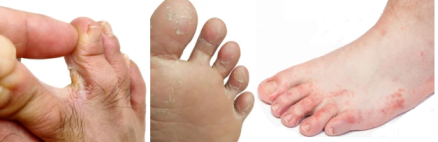 Voetschimmel | Jeuk onder voeten | Oplossing | Sproet