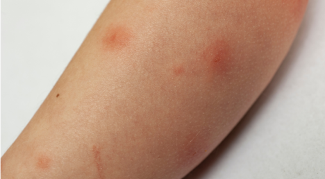 Muggenbulten: zwelling na muggenbeet | Sproet