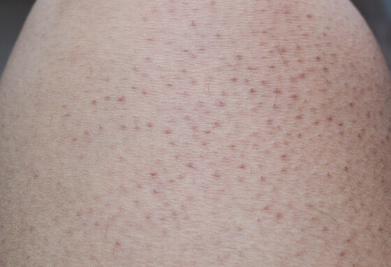 Ontstoken haarzakjes | Oorzaak en behandeling | Sproet