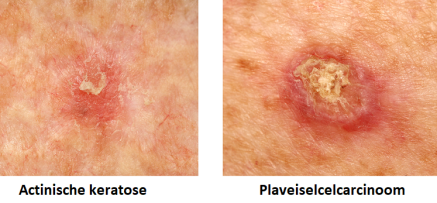 Bultjes op hoofdhuid | Oorzaken en oplossingen | Sproet