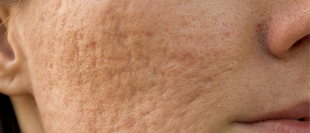 Littekens | Verschillende soorten, oorzaken en tips | Sproet